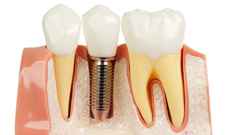 DENTAL IMPLANTS – Odontologia en Cali